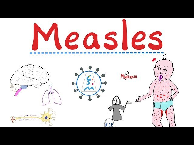 Free Video: Measles (Rubeola) - Comprehensive Explanation of Rash and ...