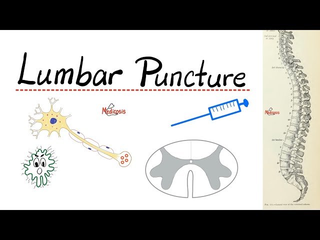 Free Video: Lumbar Puncture, CSF Analysis, and Spinal and Epidural ...