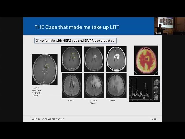 Free Video: MRI-Guided Laser Ablation for Management of Brain ...