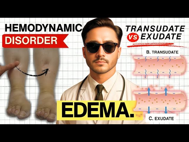Free Video: Edema Pathology - Hemodynamic Disorders and Transudate vs ...