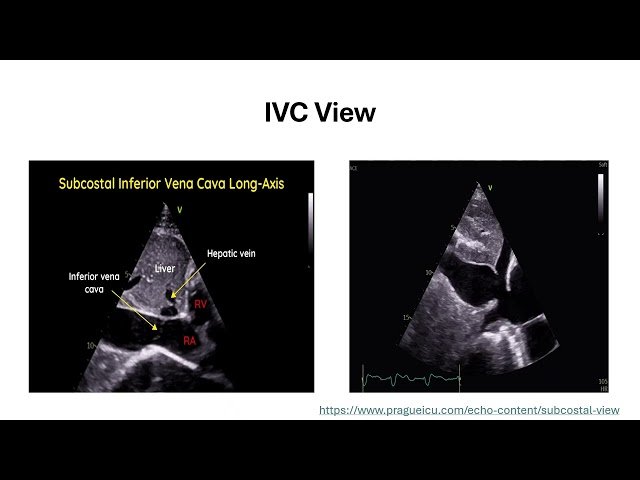 Free Video: Basic Introduction to Cardiac POCUS - Part 1 from ...