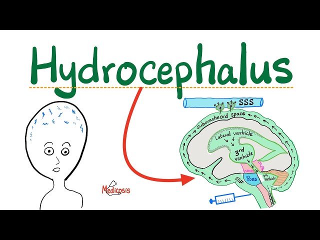 Free Video: Types of Hydrocephalus - Communicating, Noncommunicating ...