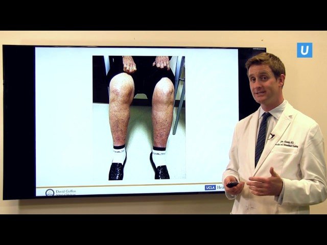 Free Video: IVC Filters - What You Need to Know - John Moriarty, MD - UCLAMDChat from University ...