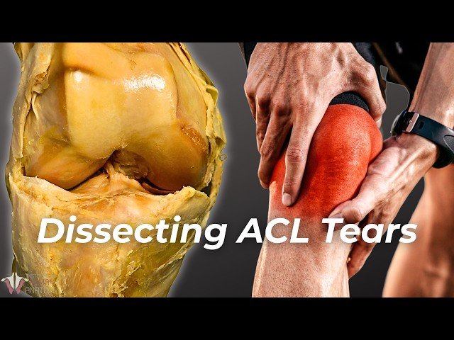 Free Video: What a Torn ACL Really Looks Like - Cadaver Dissection Explained from Institute of ...