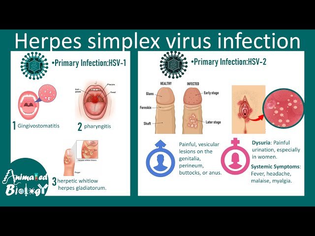 Free Video: Herpes - Causes, Symptoms, Diagnosis, Treatment, and ...