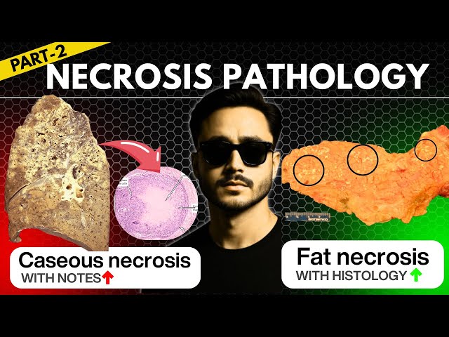 Free Video: Caseous Necrosis, Fat Necrosis, and Fibrinoid Necrosis ...