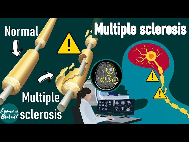 Free Video: Multiple Sclerosis Explained - Causes, Symptoms, Diagnosis and Treatment ...