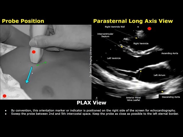 Free Video: Echocardiography Probe Positioning and Scanning Techniques - PLAX, PSAX, Subcostal ...