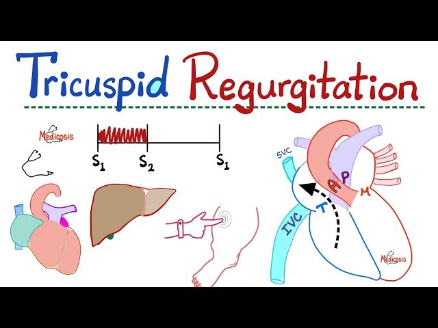 Free Video: Tricuspid Regurgitation and Valvular Heart Disease ...